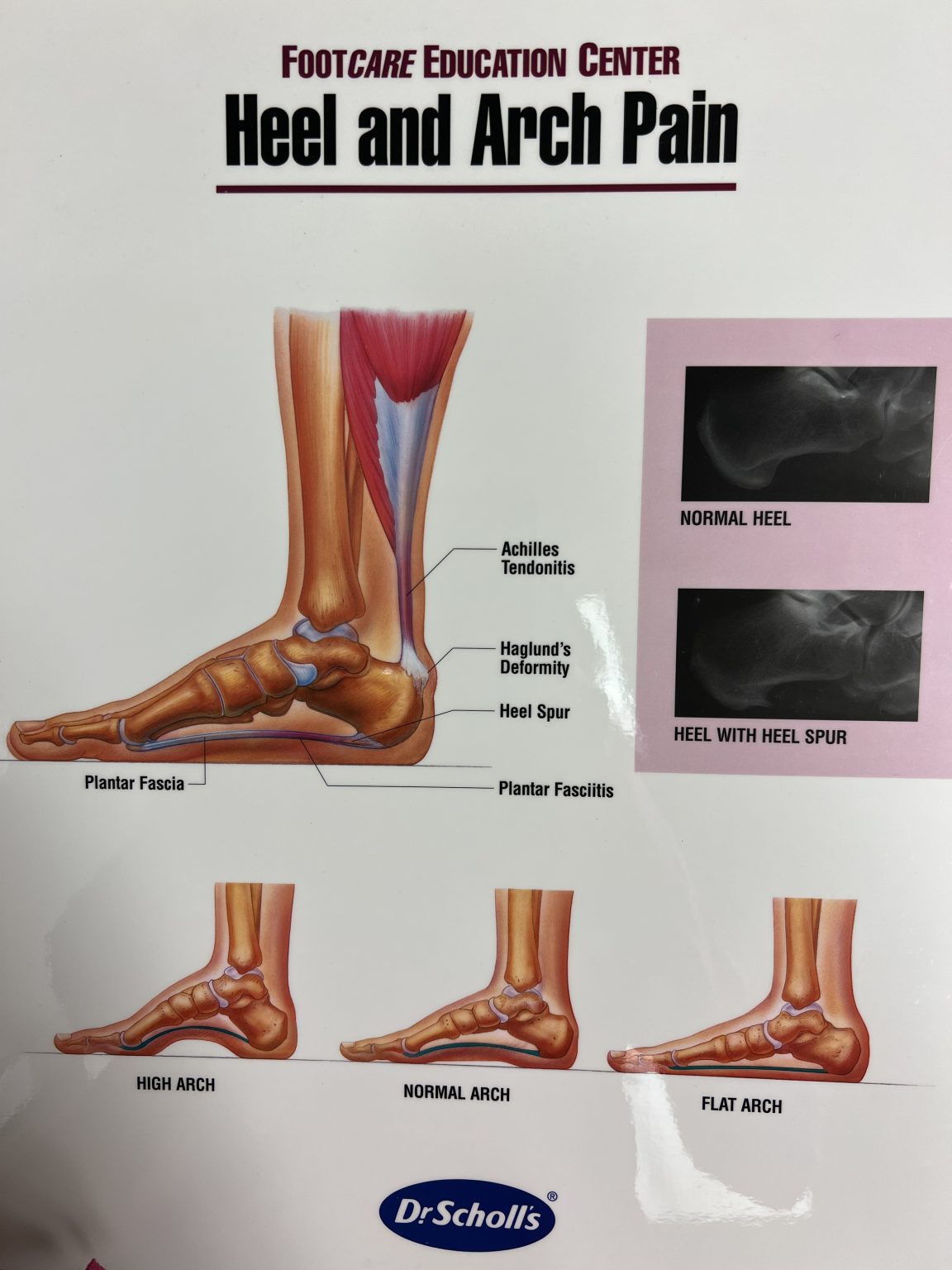 Types of Arches that get plantar fasciitis – Archmaker